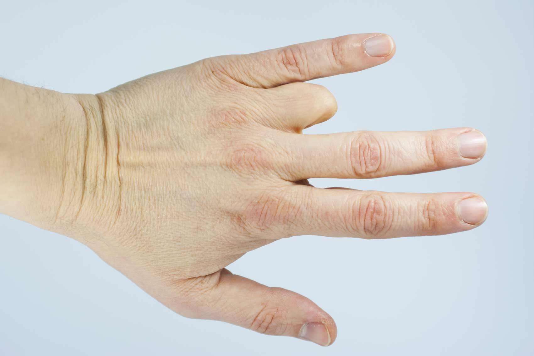 Amputated Finger Concept Map
