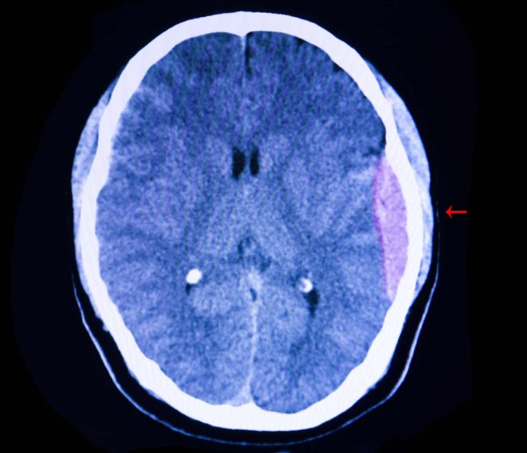 Subdural vs Epidural Hematomas - Diller Law Personal Injury Law